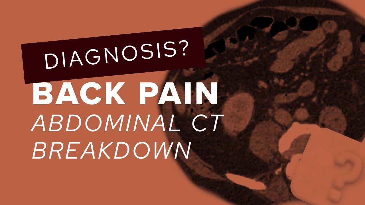 Abdominal CT breakdown: assessing back pain - YouTube