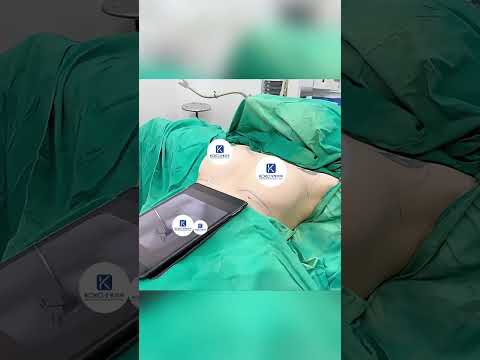 Cuplikan operasi pembesaran payudara pagi ini di Dr.KOKO.