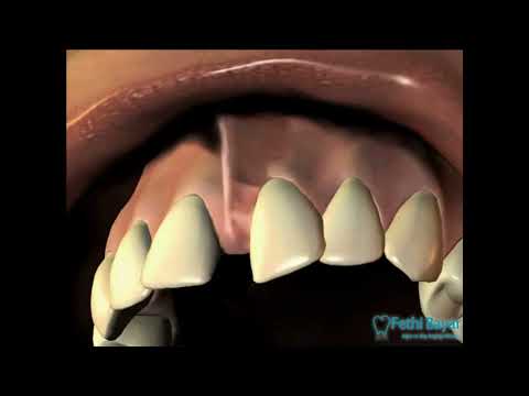 FRENEKTOMİ TEDAVİSİ NASIL UYGULANIR?