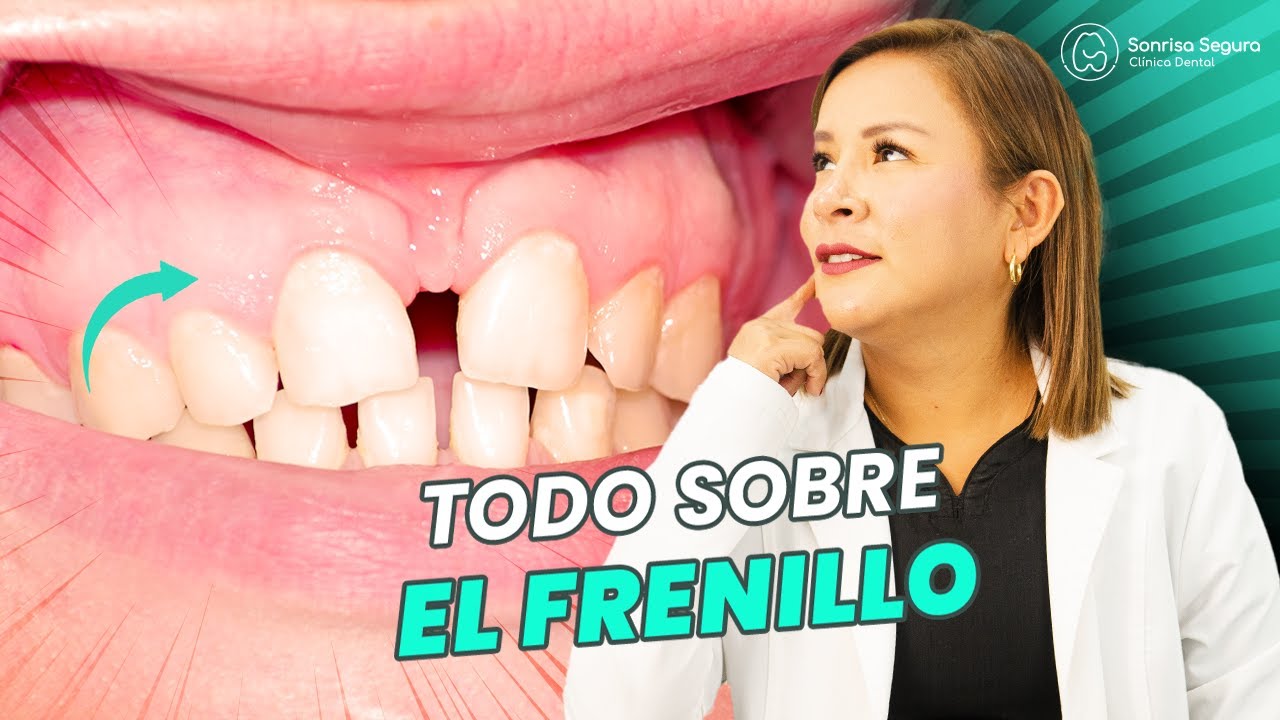 Frenillo Lingual: Tratamiento y Soluciones - YouTube