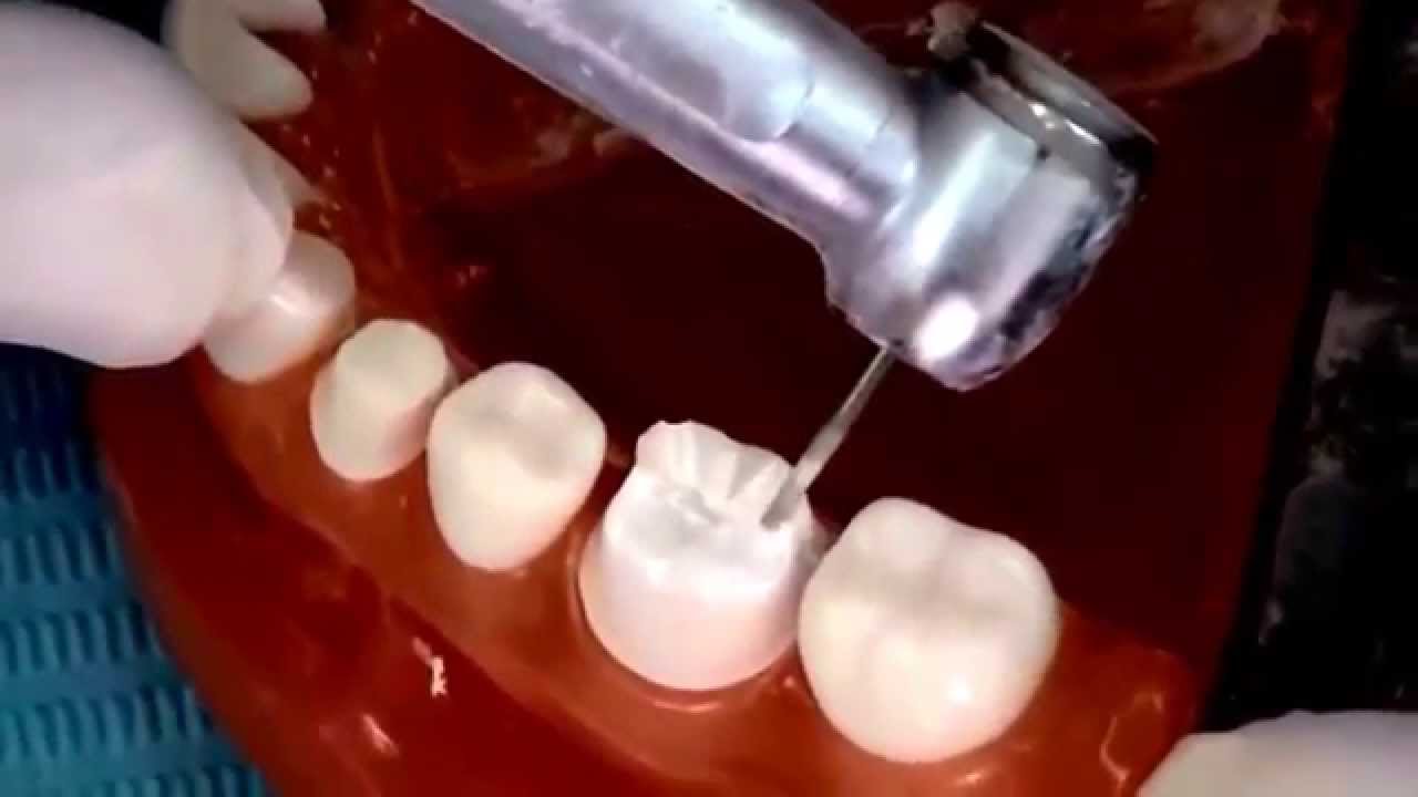 Metal Ceramic Crown Preparation [For Dental Students] HD - YouTube