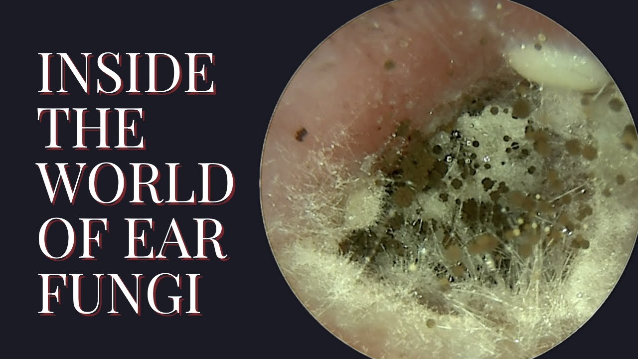 Inside The World of EAR FUNGI - YouTube