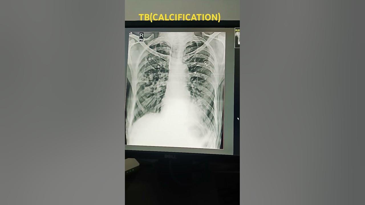 XRAY Chest PA CALCIFICATION BVM TUBERCULOSIS - YouTube