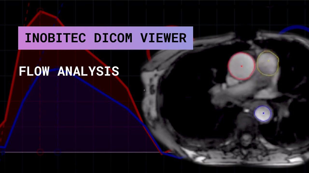 The Flow Analysis with Inobitec DICOM Viewer Pro - YouTube
