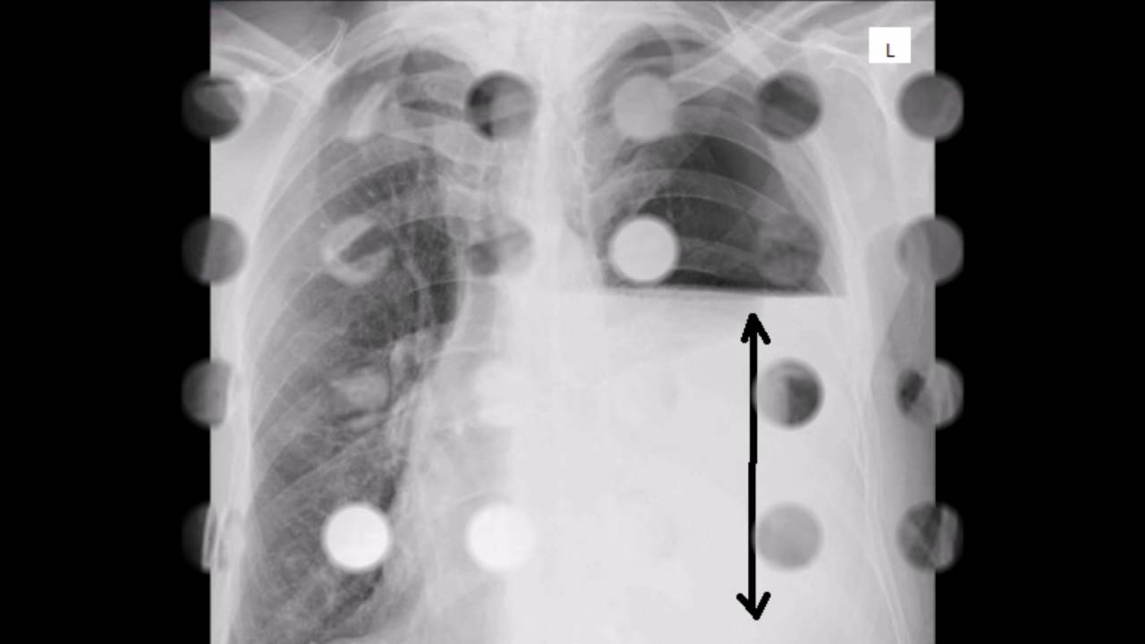 Rx de Tórax / Algunas Patologías - YouTube