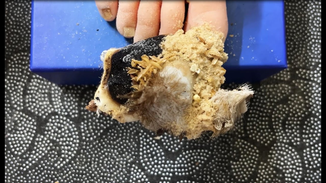 INGROWN TOENAILS, The nail is embedded super deep and there is a hole ...