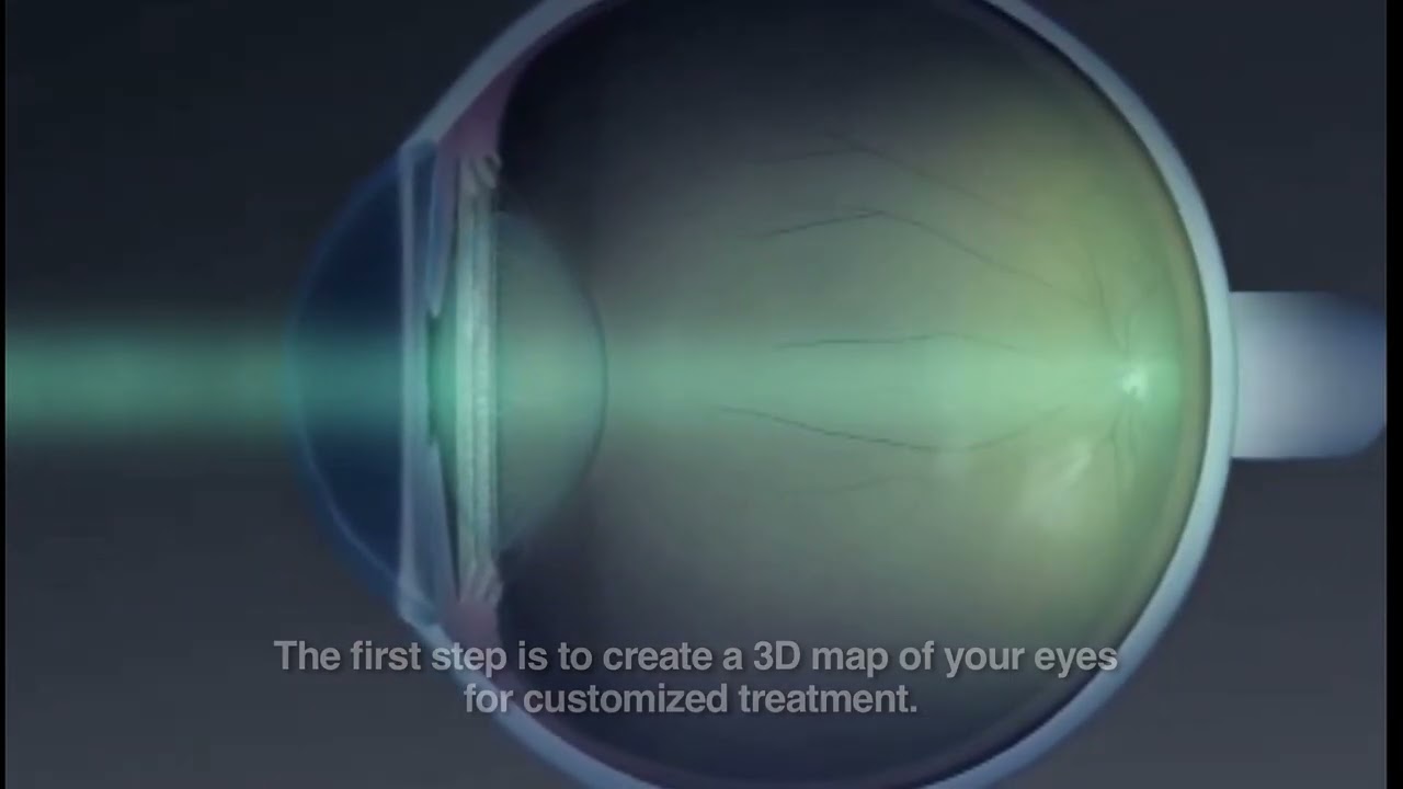 iLASIK procedure video step 1 - YouTube