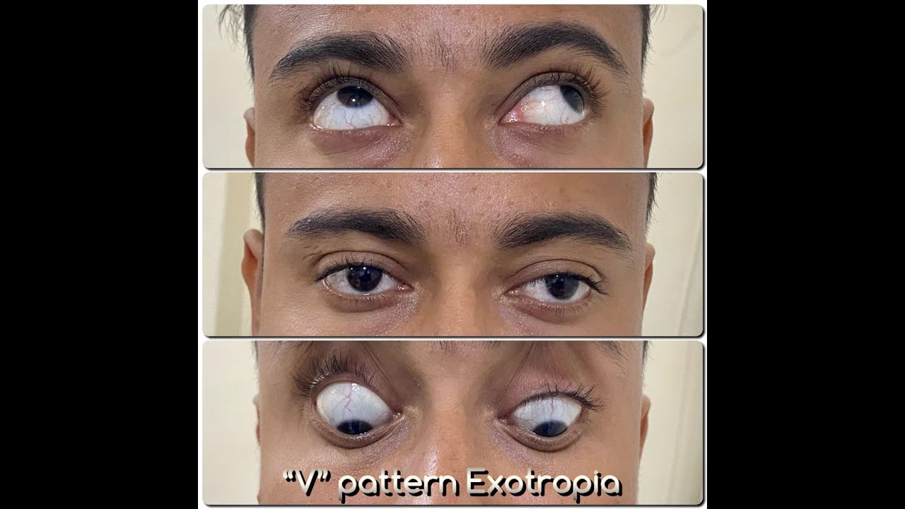 Inferior Oblique muscle recession (fornix incision) for V pattern ...