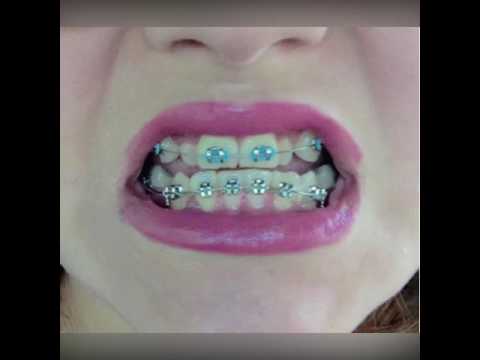 Ortodoncia con extraccion de Los premolares - YouTube