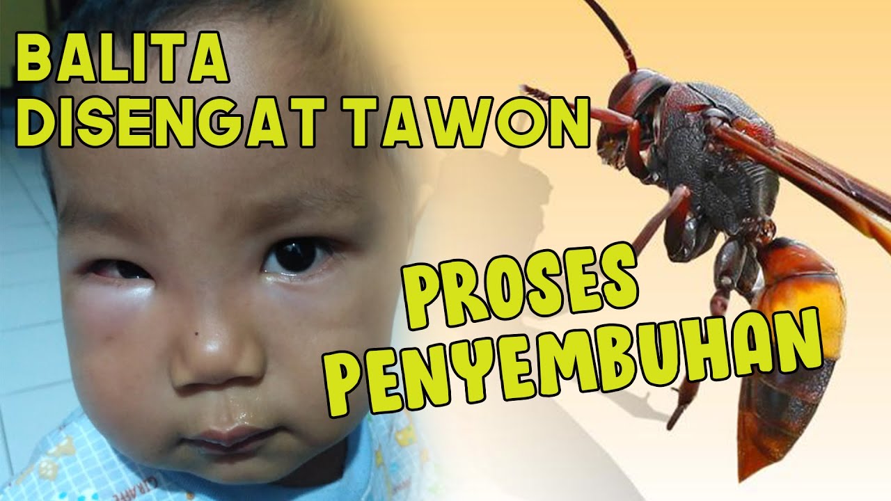 PROSES PENYEMBUHAN ANAK KECIL DISENGAT TAWON | pengobatan sengatan ...
