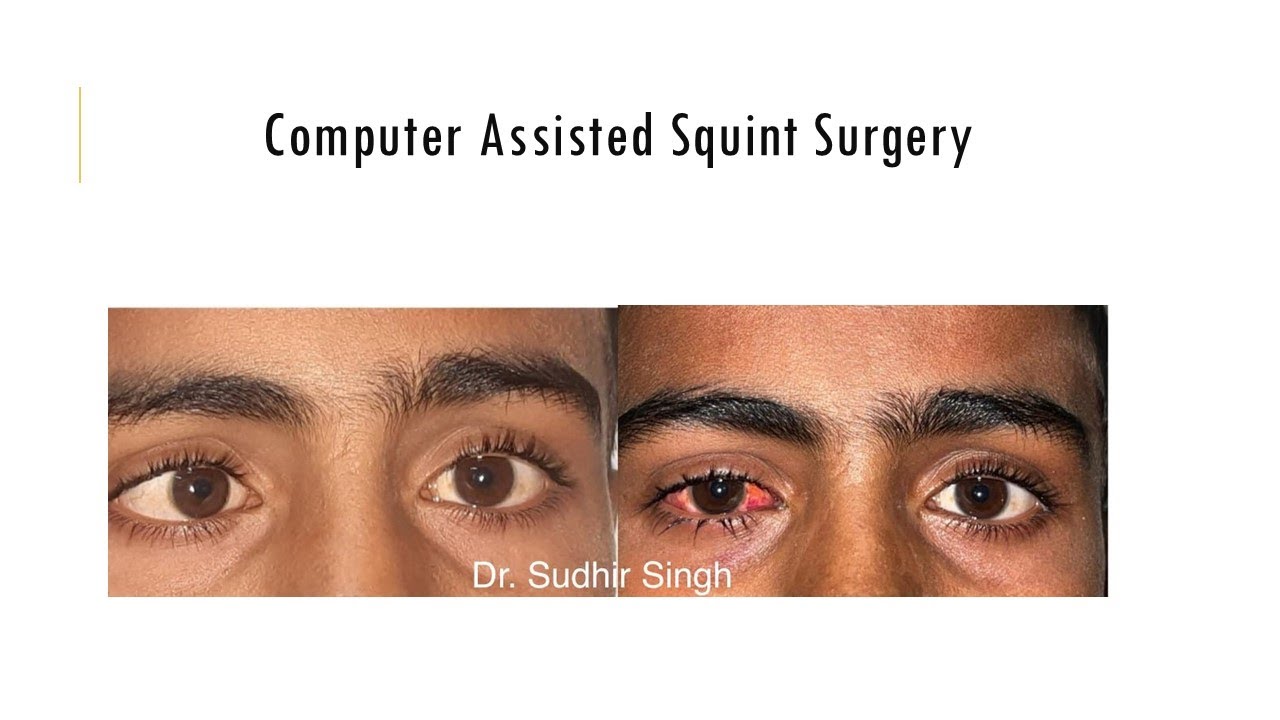 Computer Assisted Squint Surgery - YouTube