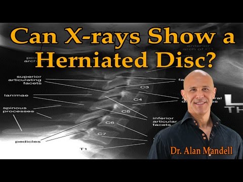 Will Herniated Disc Show Up On Ct Or Xray