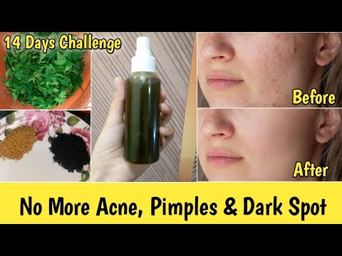 14 Days Challenge - No More ACNE, Pimples & Dark Spots||Get FAIR ...