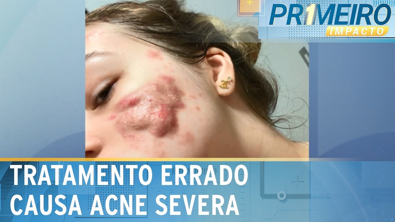Tratamento errado faz jovem sofrer com acne severa, deixando marcas ...