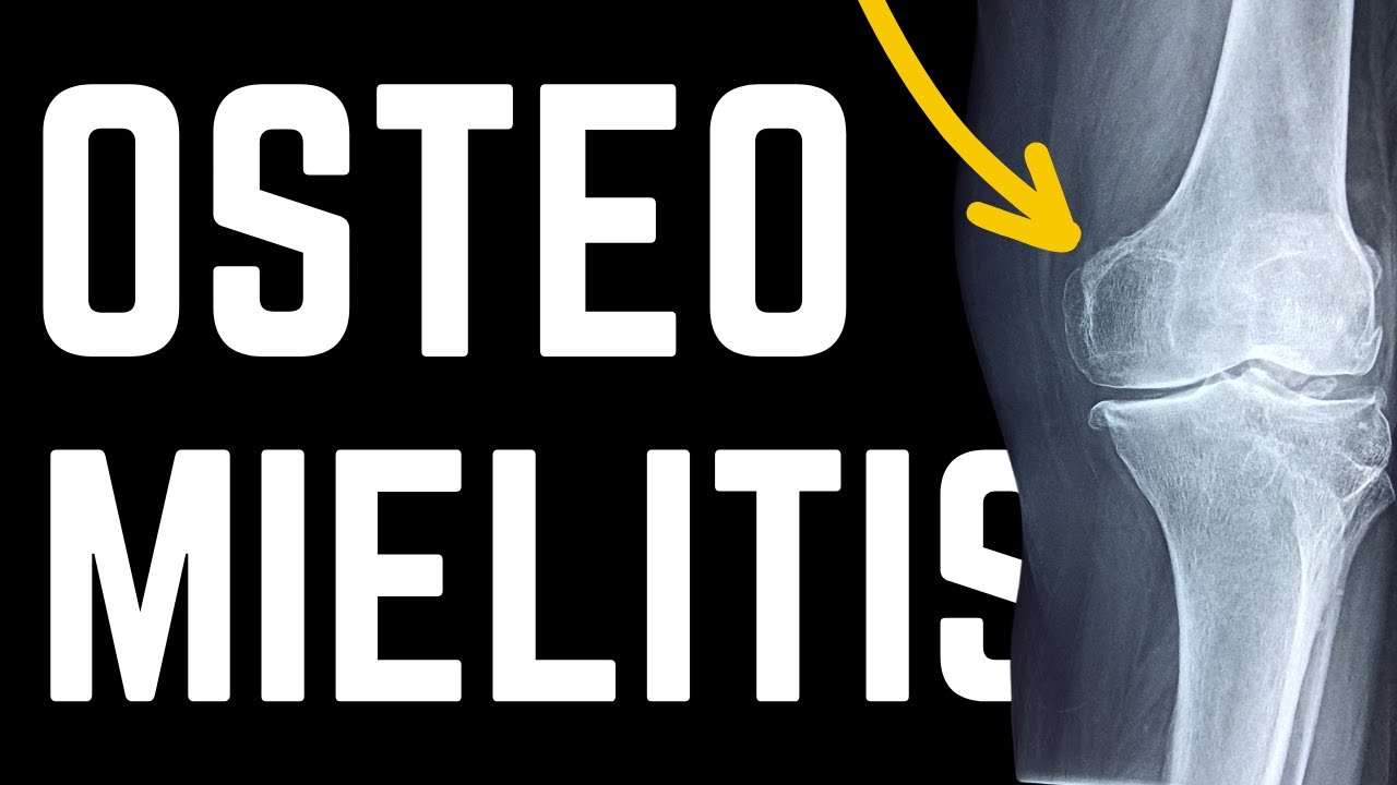 Osteomielitis Explicado Claramente - YouTube