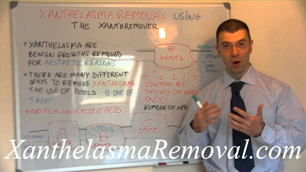 How does the XanthRemover work? - YouTube