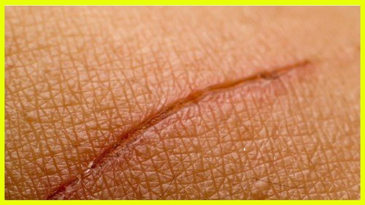Narben: Tipps für Behandlung und Heilung - YouTube