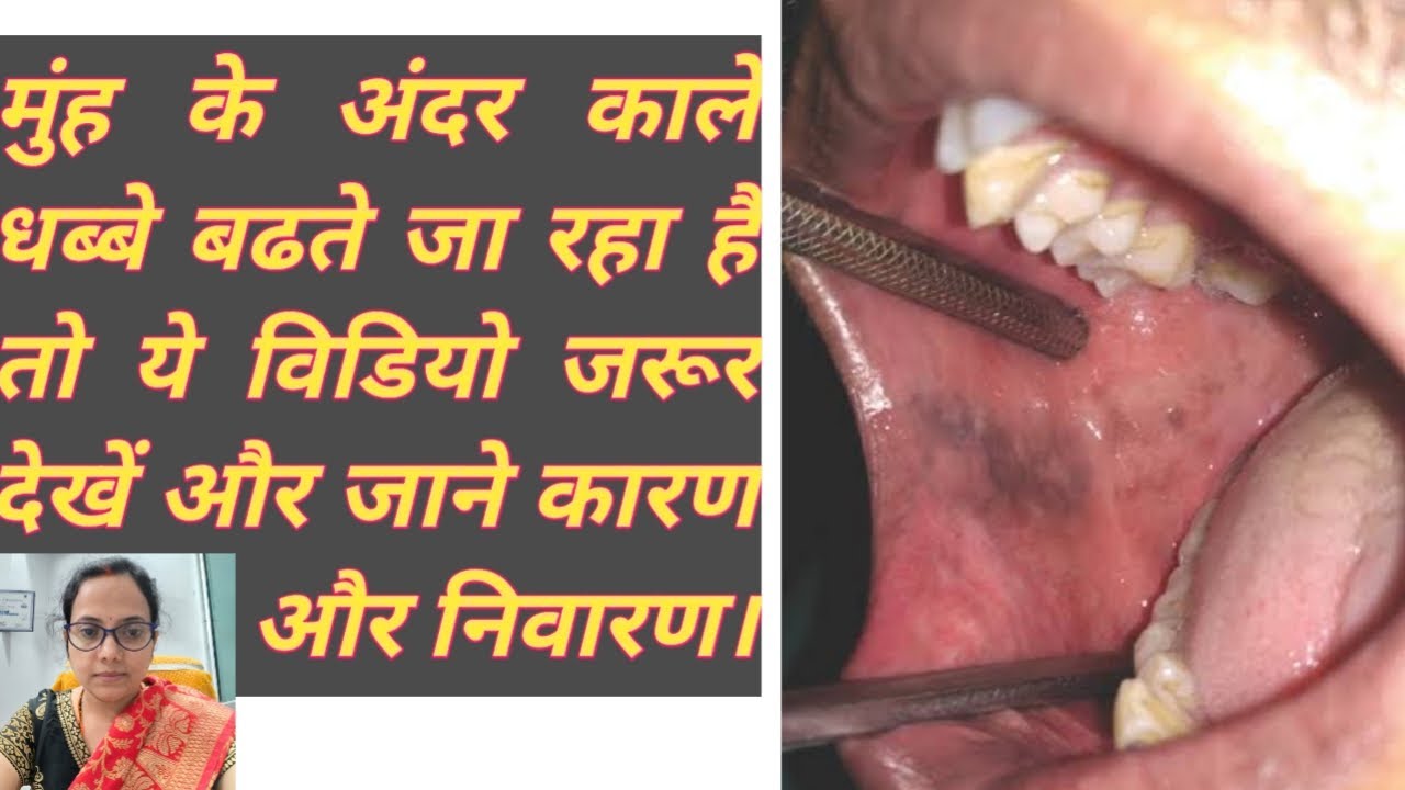 Muh ke andar kale dhabbe ban gy hai.मुंह के अंदर काले धब्बे बढते जा रहे ...