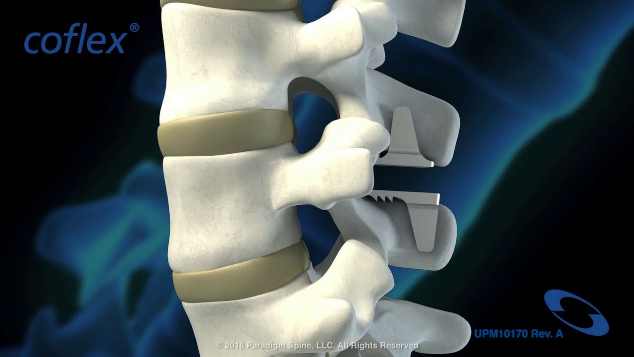 coflex single level flexion extension 3 - YouTube