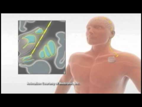 Brain Pacemaker For Alzheimer's Treatment - YouTube