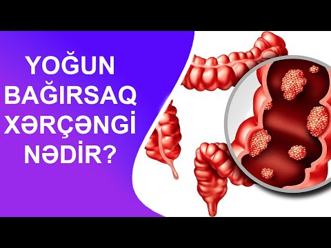 YOĞUN BAĞIRSAQ XƏRÇƏNGİ NƏDİR❓