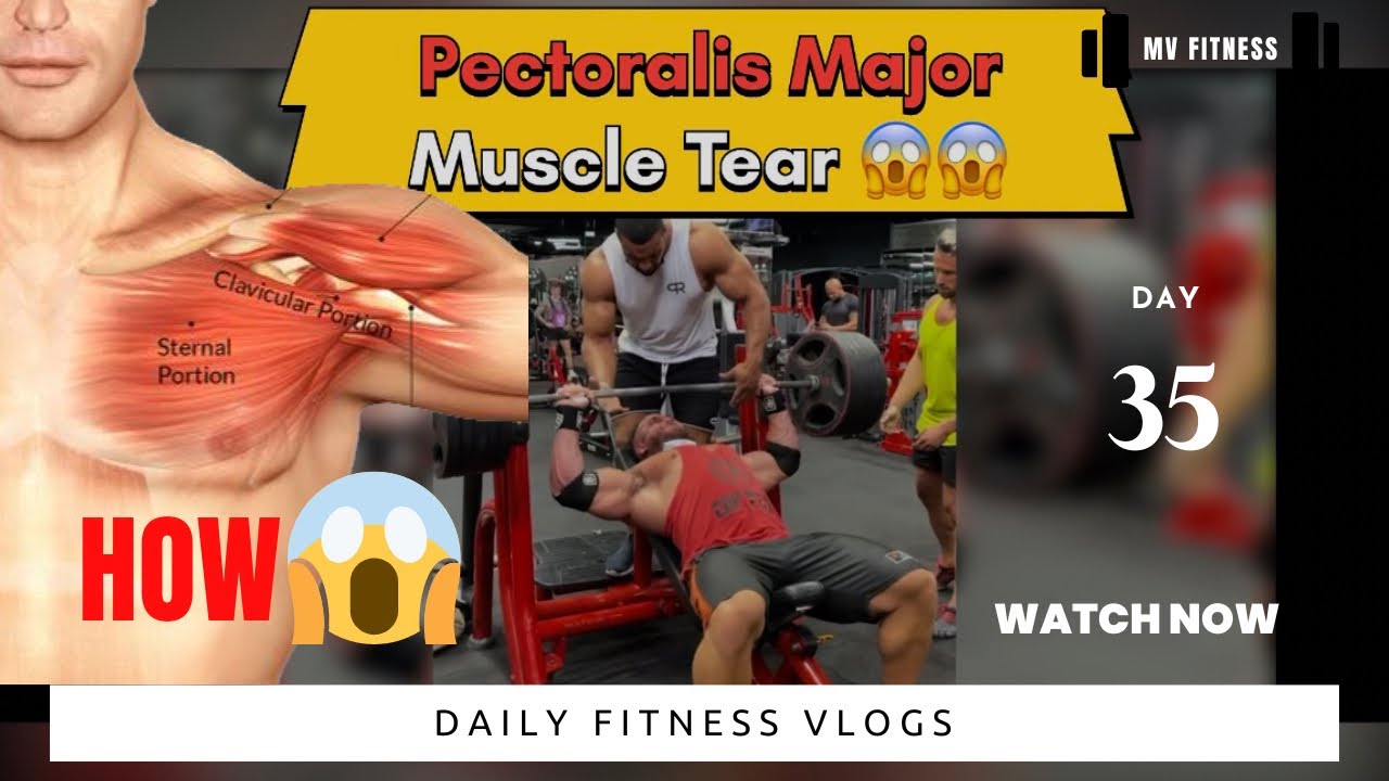 Pectoralis Major Muscle Tear 😱 (Day-35) - YouTube