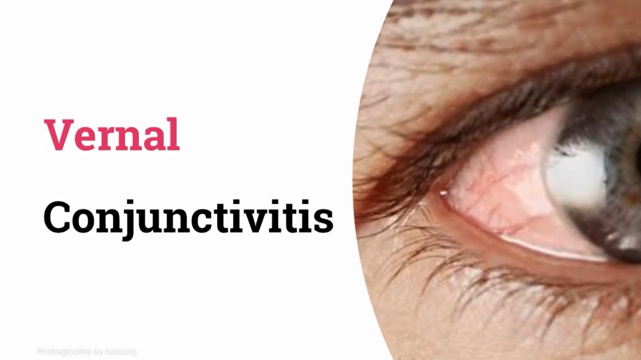 Spring catarrh (vernal conjunctivitis) - YouTube