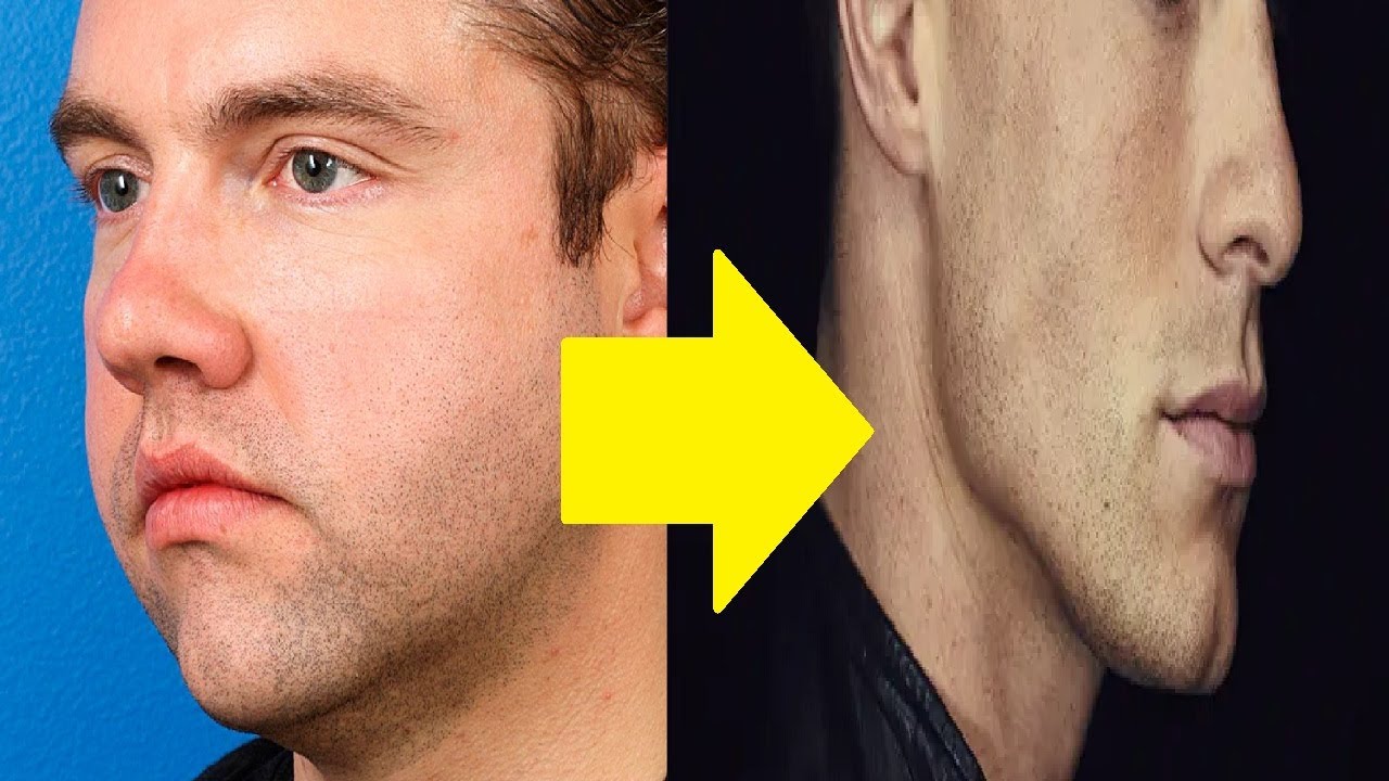 how to get rid of chubby cheeks when smiling fast - YouTube