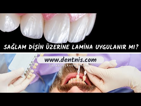 Sağlam Dişin Üzerine Lamina Uygulanabilir Mi?