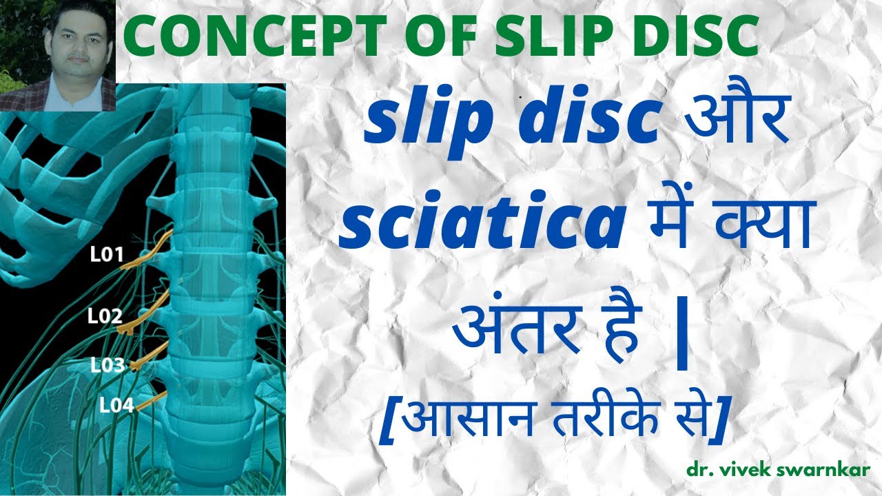 CONCEPT OF SLIP DISC/slip disc और sciatica में क्या अंतर है/slip disc ...