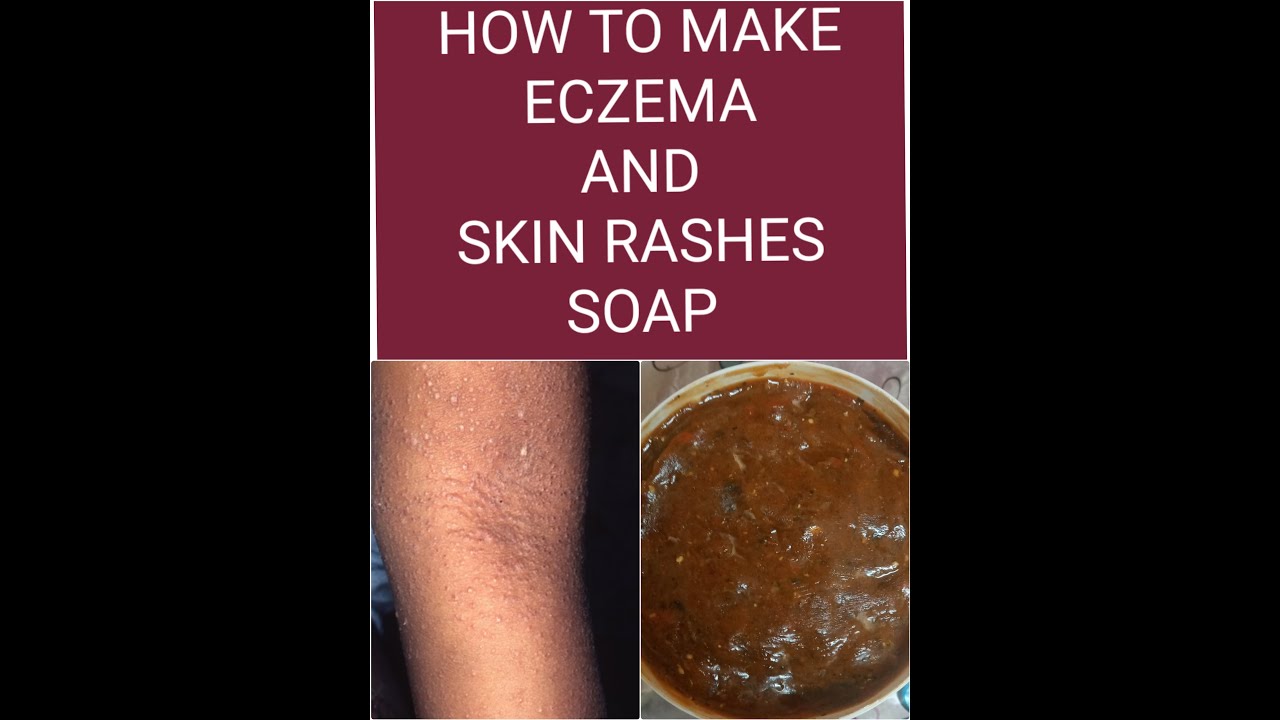 HOW TO MAKE ECZEMA AND SKIN RASHES SOAP . - YouTube