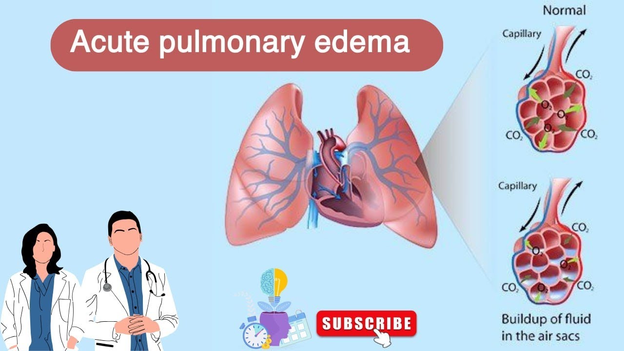 Acute pulmonary edema , الوذمة اوالأستسقاء الرئوى - YouTube