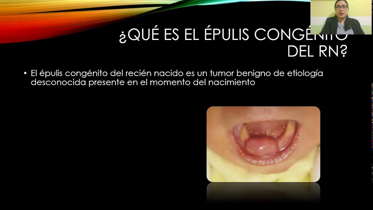 Épulis congénito del recién nacido - YouTube