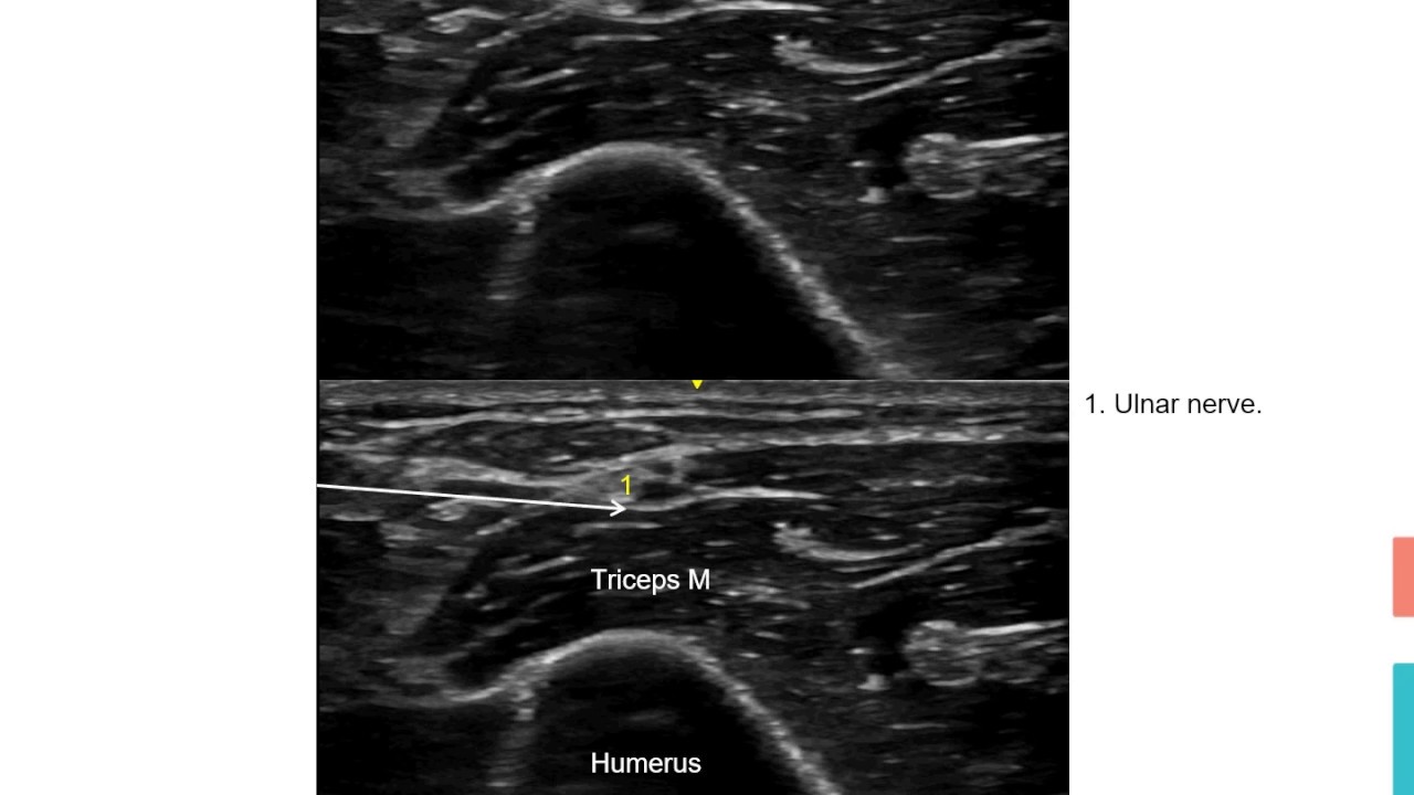 Ulnar nerve block Elbow - YouTube