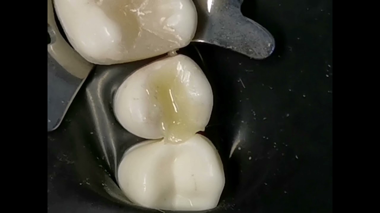 Composite restoration class 1 upper premolar - YouTube