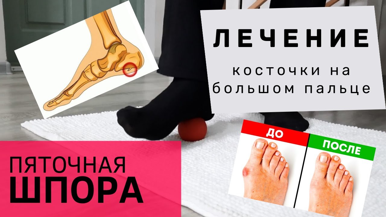 Косточка на большом пальце ноги и пяточная шпора Самомассаж Youtube