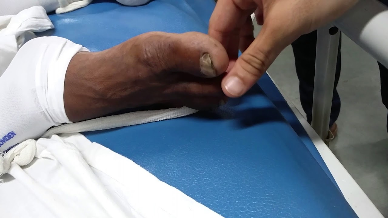 Gonda sign - Plantar equivalent of Babinski sign - YouTube