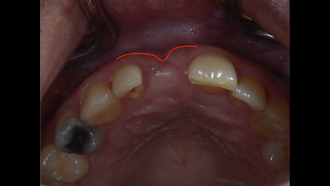 implant and soft tissue augmentation - YouTube