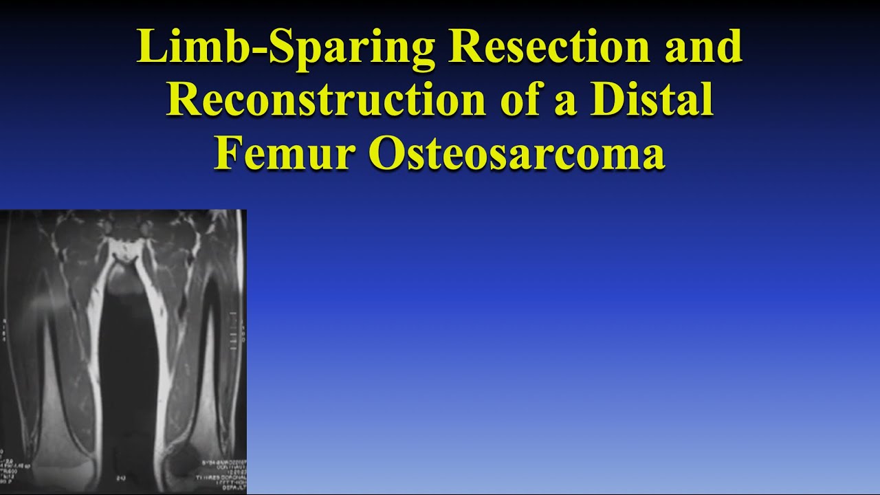 Limb-Sparing Resection and Reconstruction of a Distal Femur ...