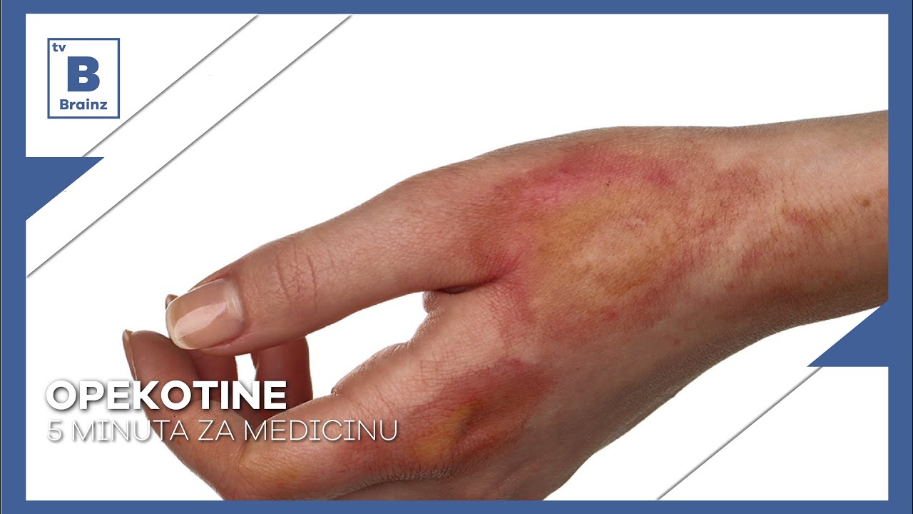 5 minuta za medicinu - Opekotine - YouTube