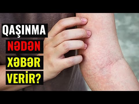DİQQƏT! Bədəndə QAŞINMA varsa, hansı xəstəliyin xəbərçisidir?