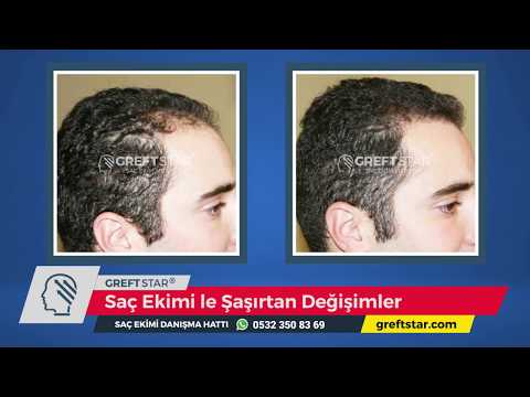 Saç Ekimi Resimleri