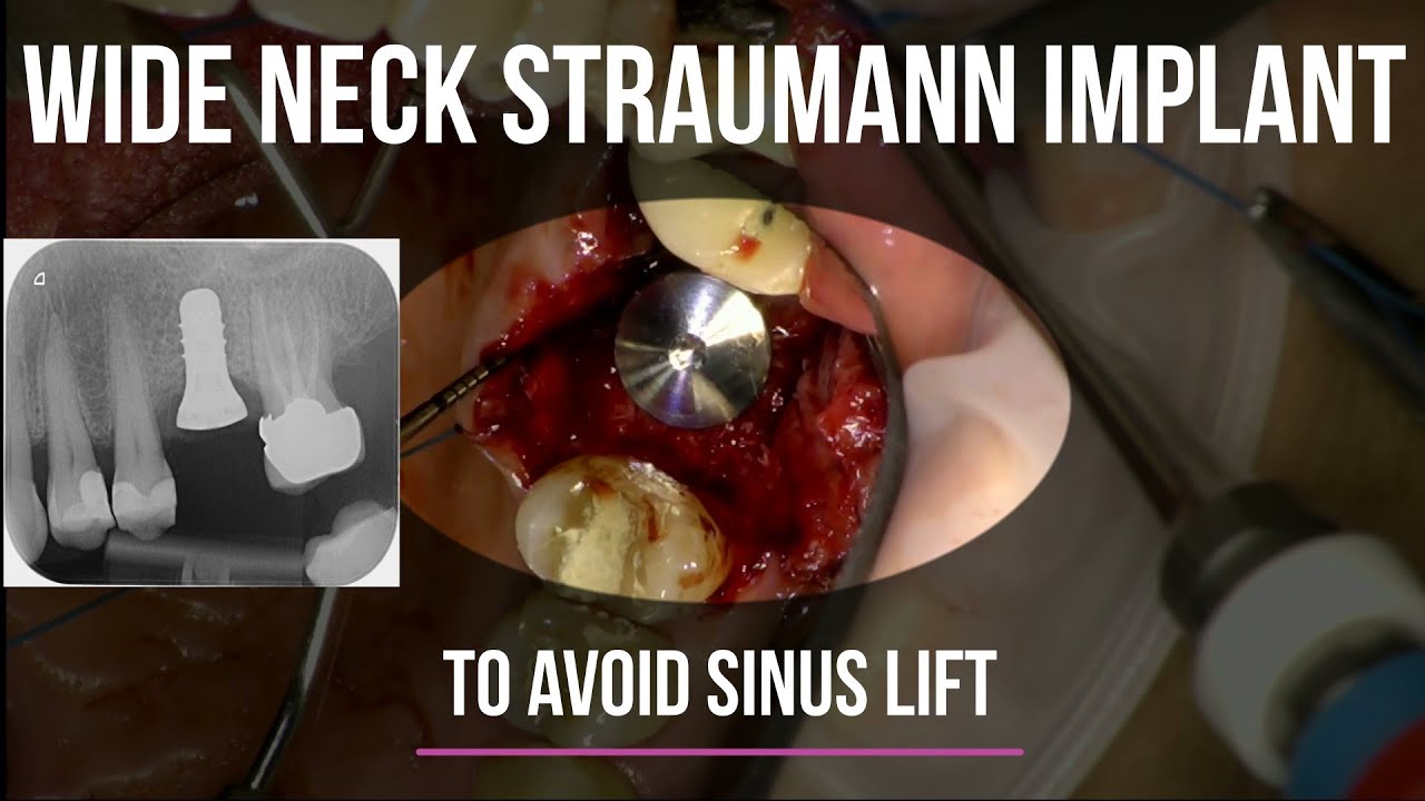 Avoiding Sinus Lift With Wide Neck Straumann Implant - YouTube