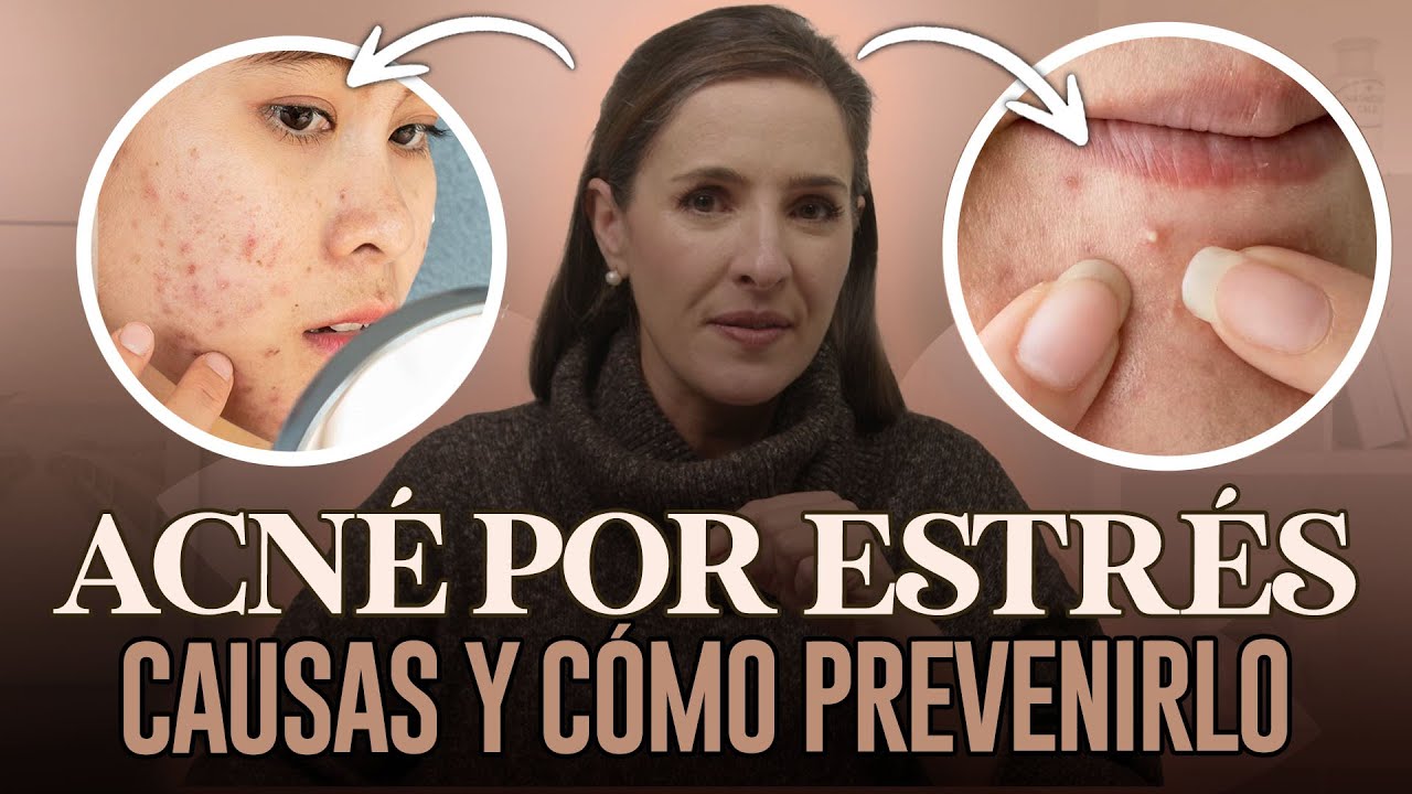 🔴 Así afecta el ESTRES a nuestra PIEL @drapilarochoa - Dermatologa ...
