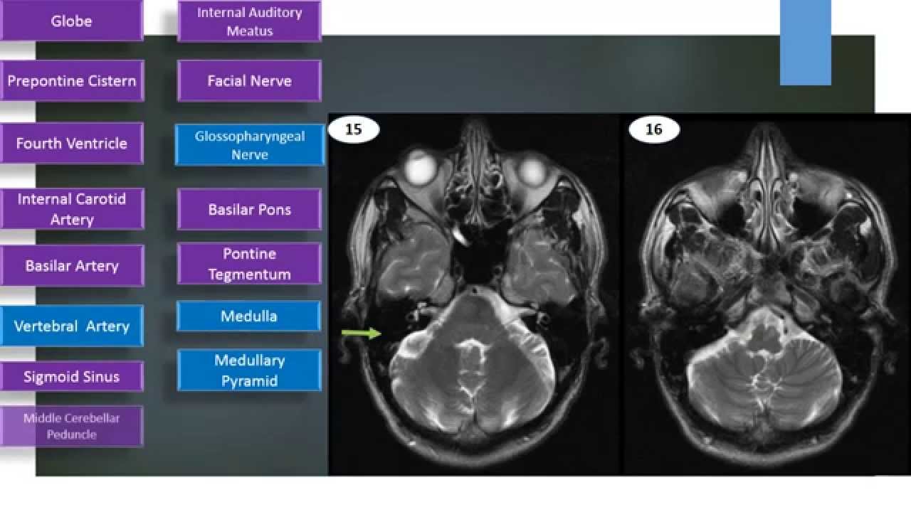 MRI Brain Sectional Anatomy Cut 15 & 16 - YouTube