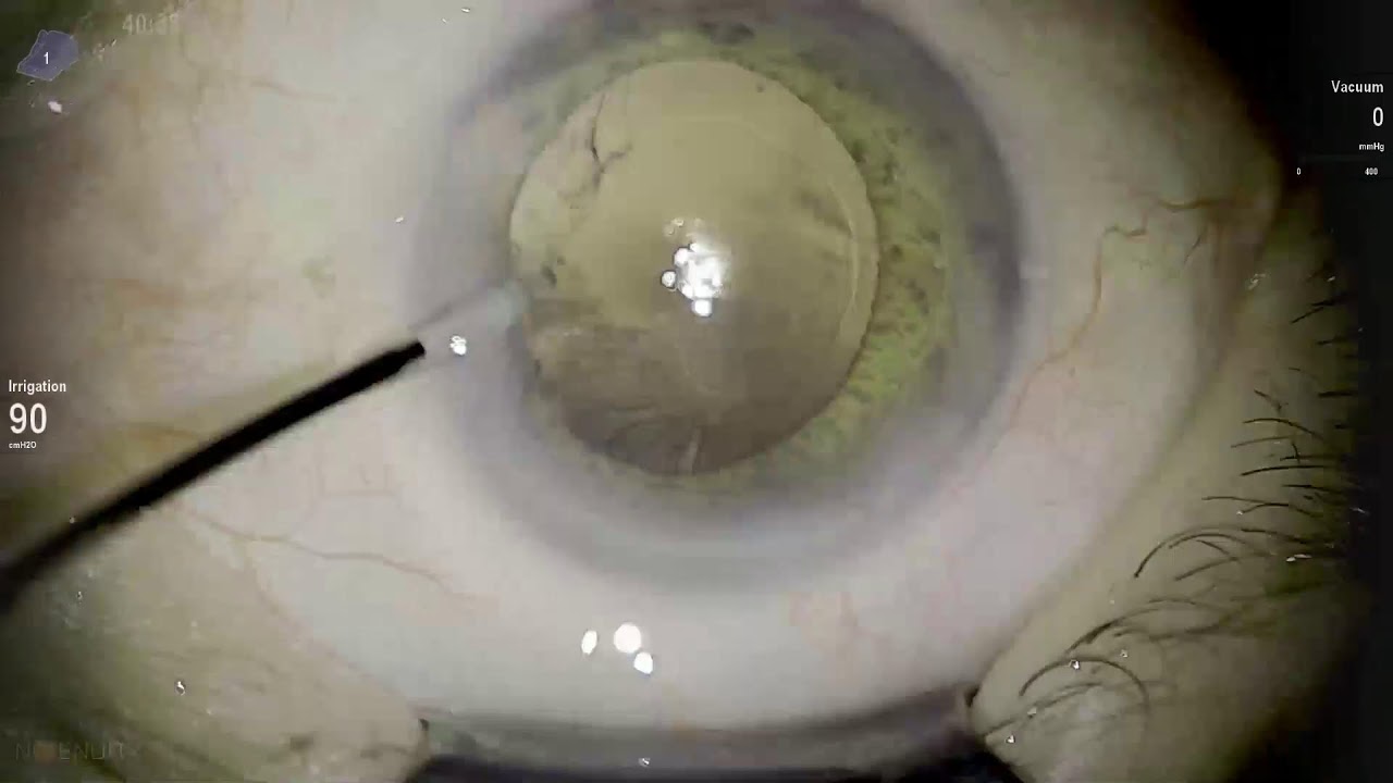 Dr Stanimir Troshev Cataract Surgery Livestream- Secondary "Carlevale ...