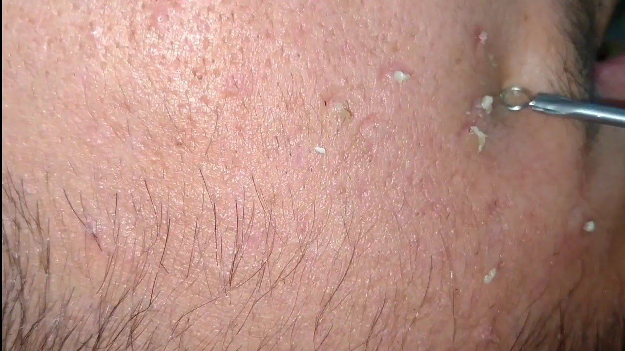 sac dep spa blackheads elderly 2024 | sac dep spa old age blackheads ...