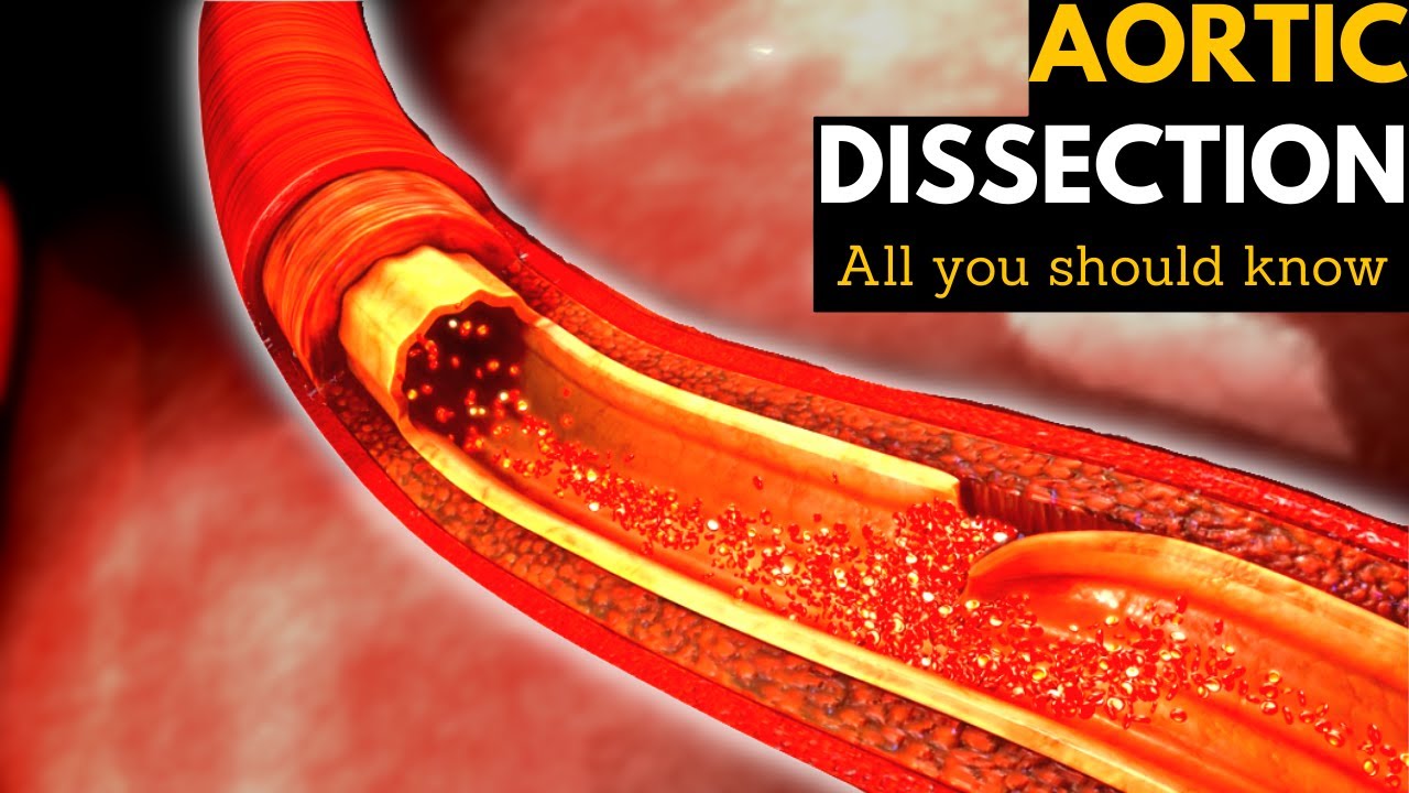 Aortic Dissection, Causes, Signs and Symptoms, Diagnosis and Treatment ...