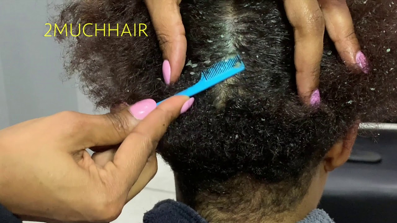 Dandruff Scratch Patch X3... Steph is Back!!! - YouTube