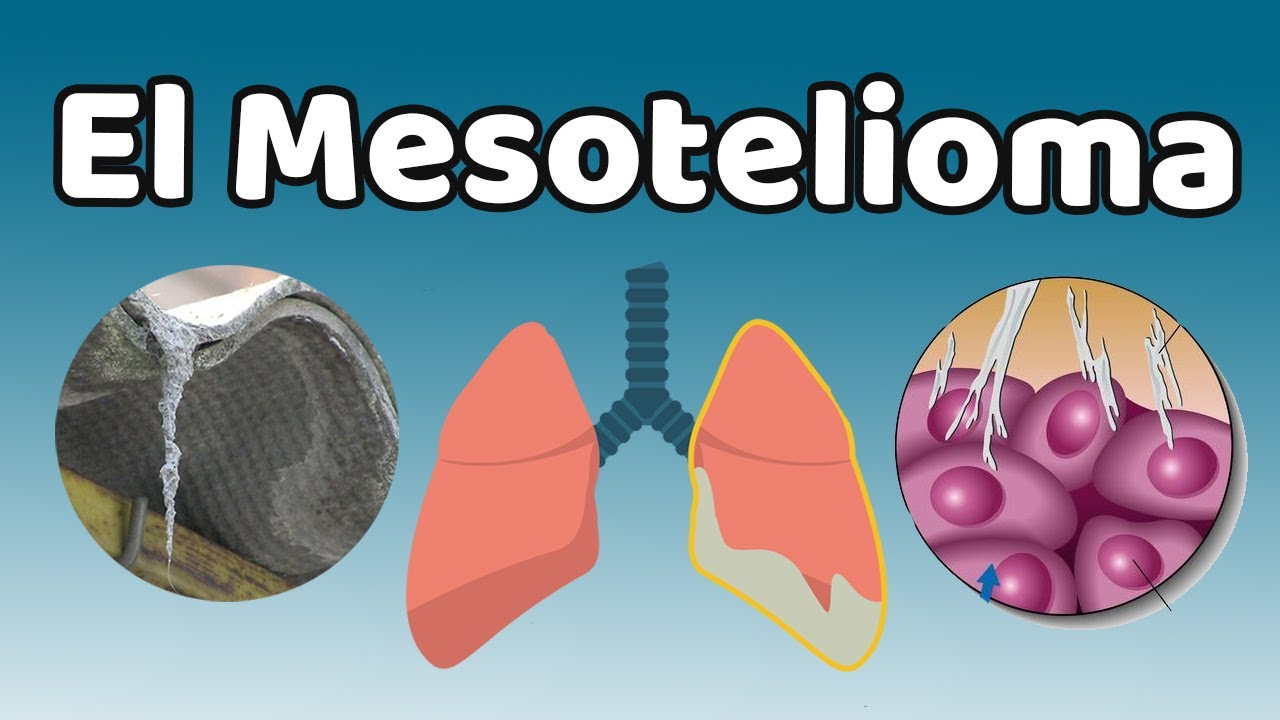 EL MESOTELIOMA, Causas, signos y síntomas, diagnóstico y tratamiento ...